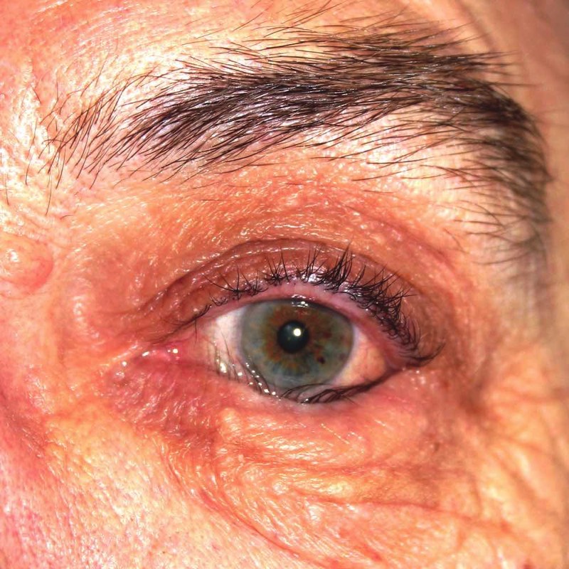 Entropion | Eyelids turn in towards eye | Eyelashes rubbing eyeball ...