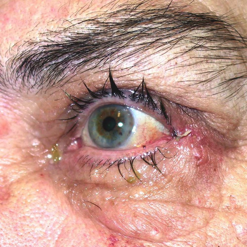 Entropion | Eyelids turn in towards eye | Eyelashes rubbing eyeball ...
